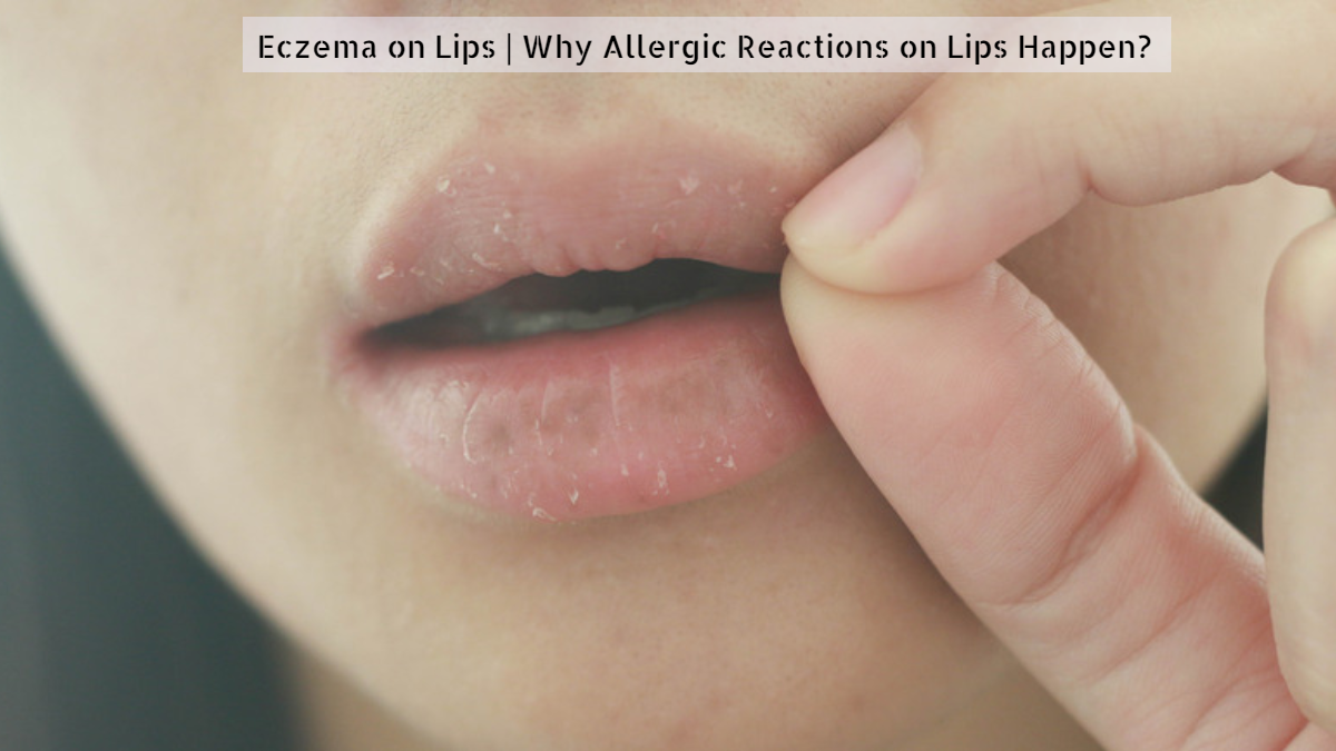 Eczema On Lips Causes Of Allergic Reactions Explained